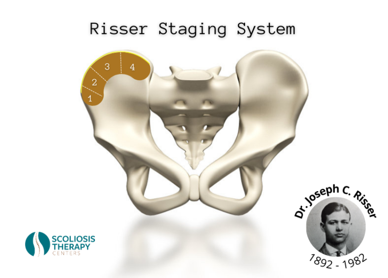 Understanding Bracing Effectiveness When Treating Adolescent Idiopathic ...