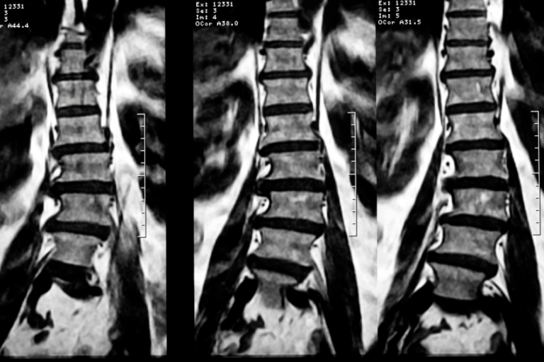 The Facts About Adult Scoliosis | Scoliosis Therapy Centers